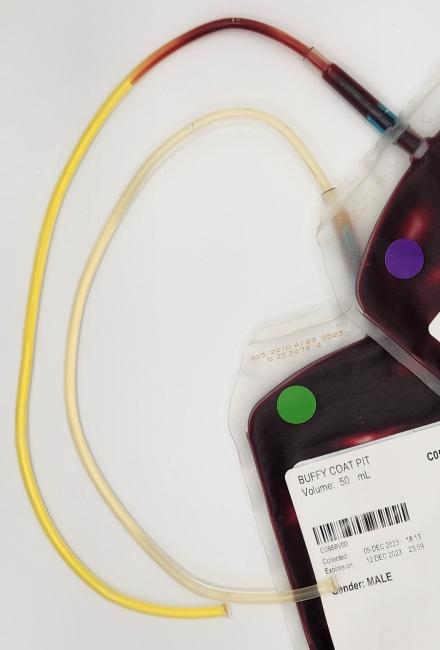 Plasma: Icterus | Professional Education