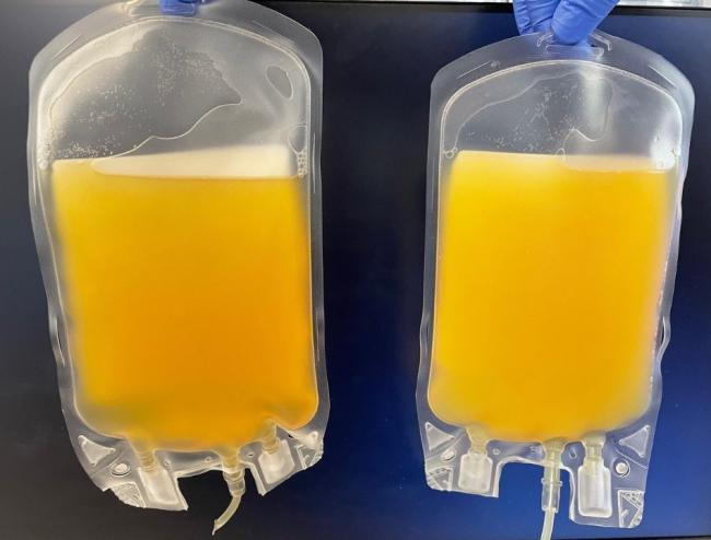 Plasma: Lipemia | Professional Education