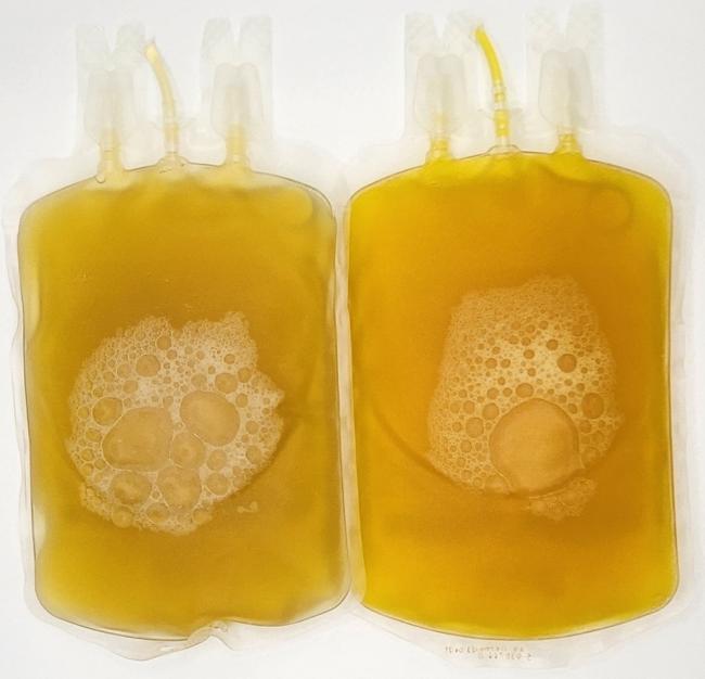 Plasma: Icterus | Professional Education