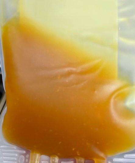 Platelets: Bacterial contamination | Professional Education